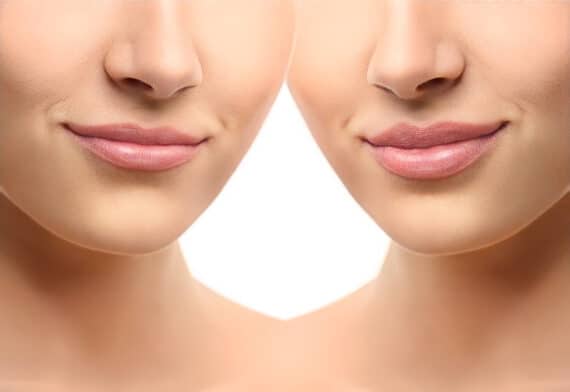 Lip Lift in New Jersey | Philadelphia | Dr. Alisa Yamasaki