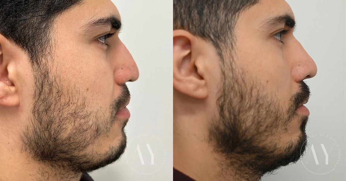 Revision Rhinoplasty New Jersey Philadelphia Dr Yamasaki